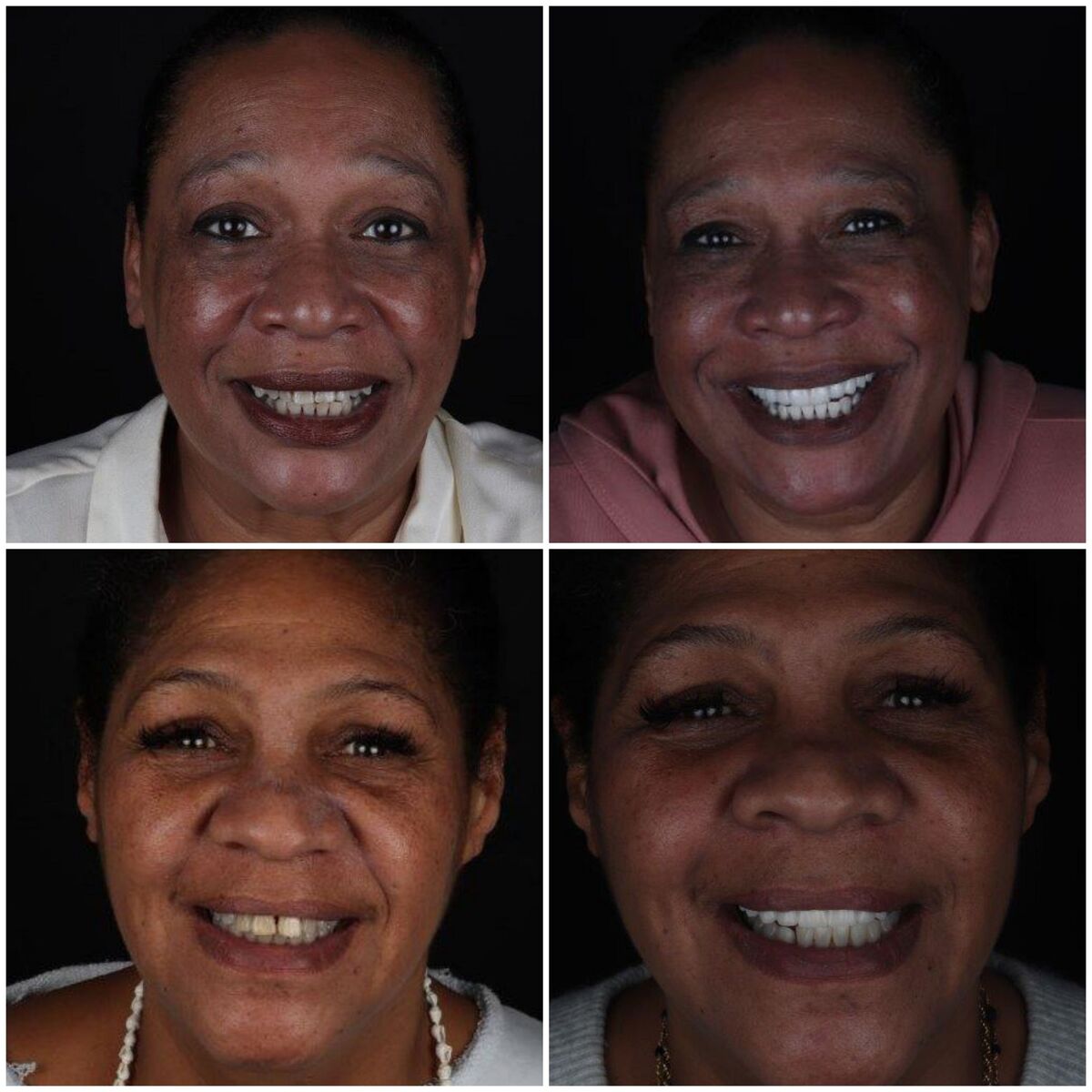 Vaste gebitsprothese Turkije