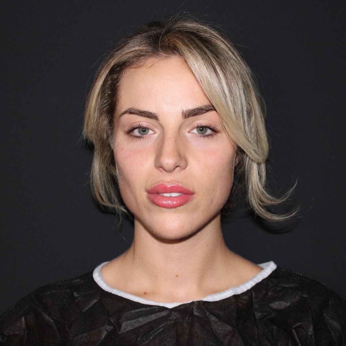 @eilishflesch neuscorrectie bij Esteworld beste keus ooit!