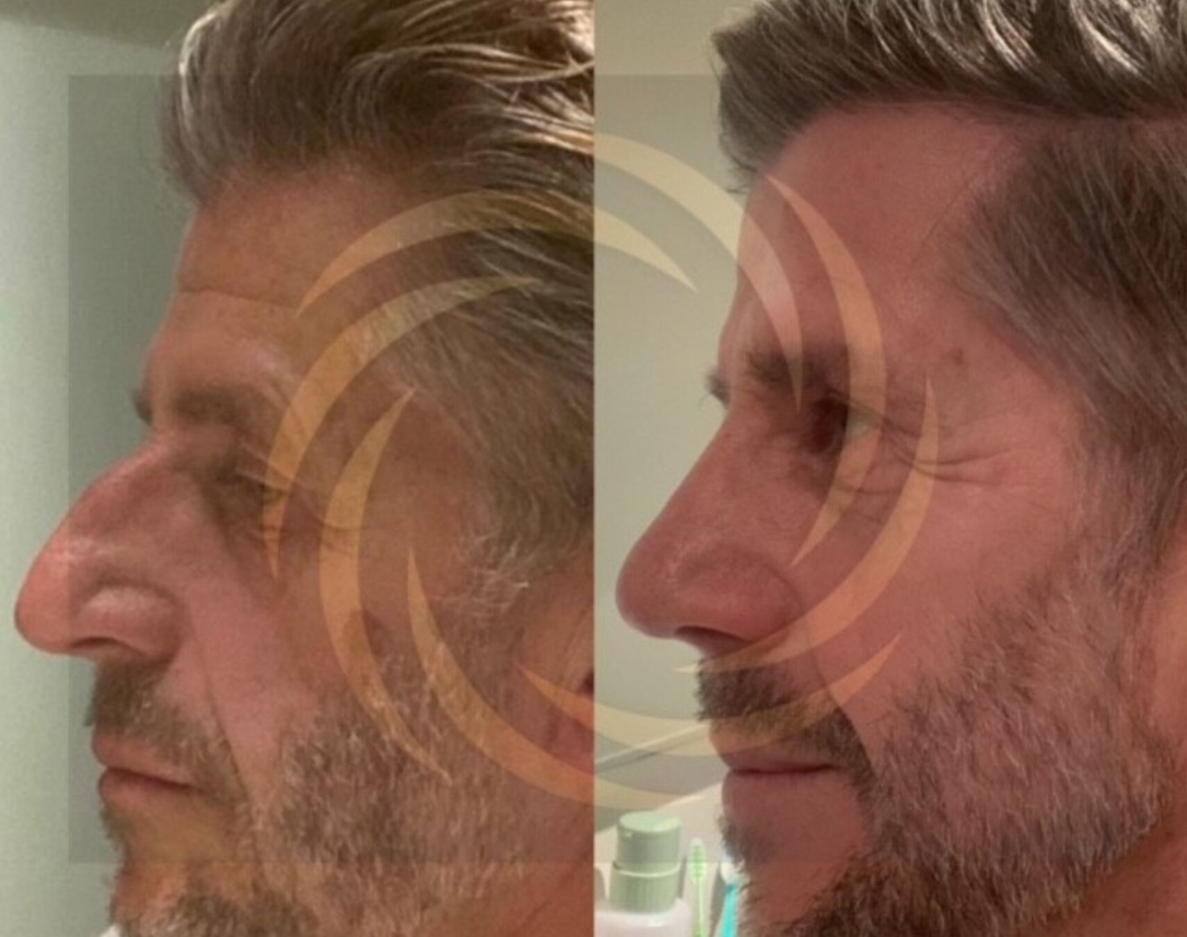 Neuscorrectie Turkije