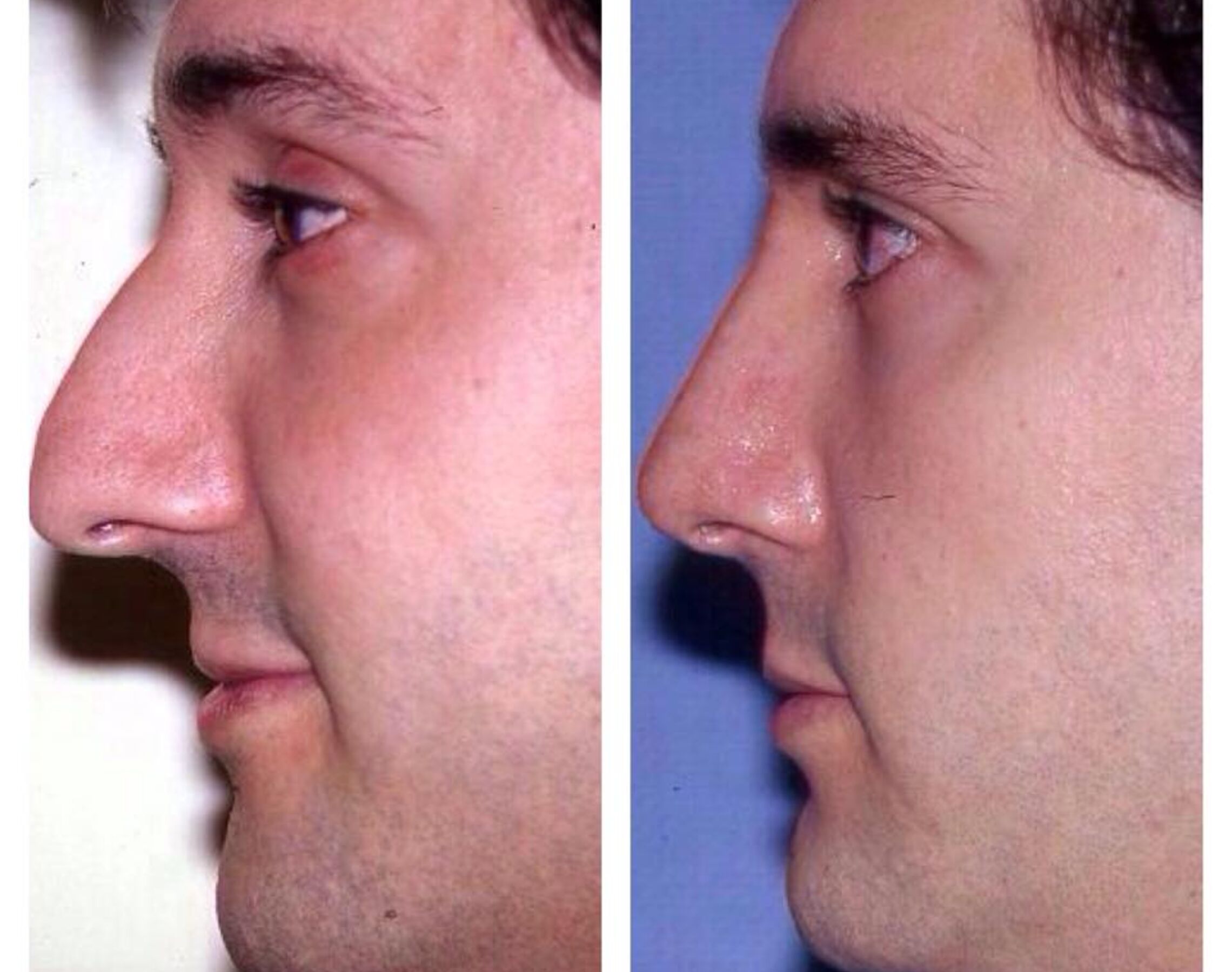 Neuscorrectie Turkije