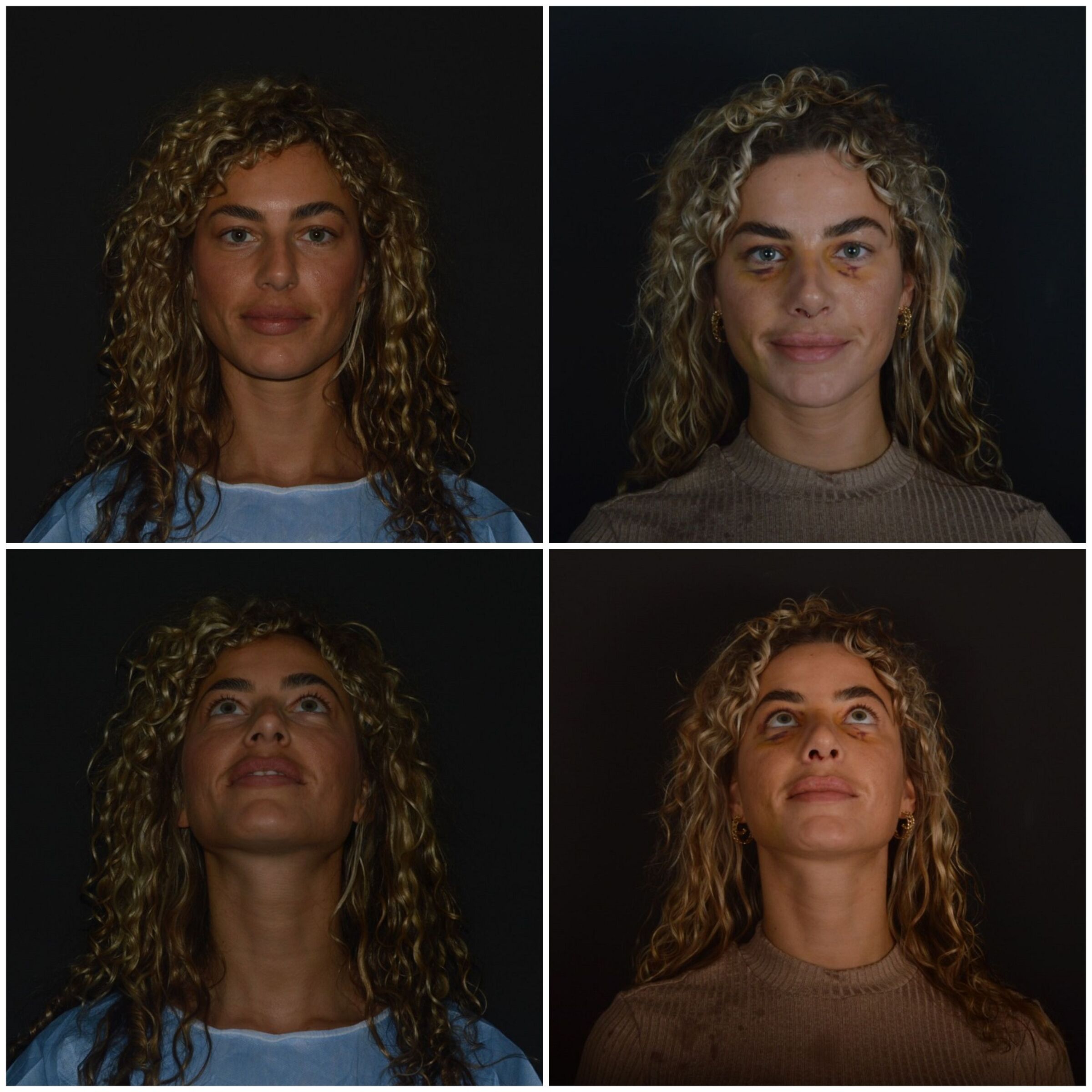 Playmate en Influencer Nena Vlaar haar neuscorrectie