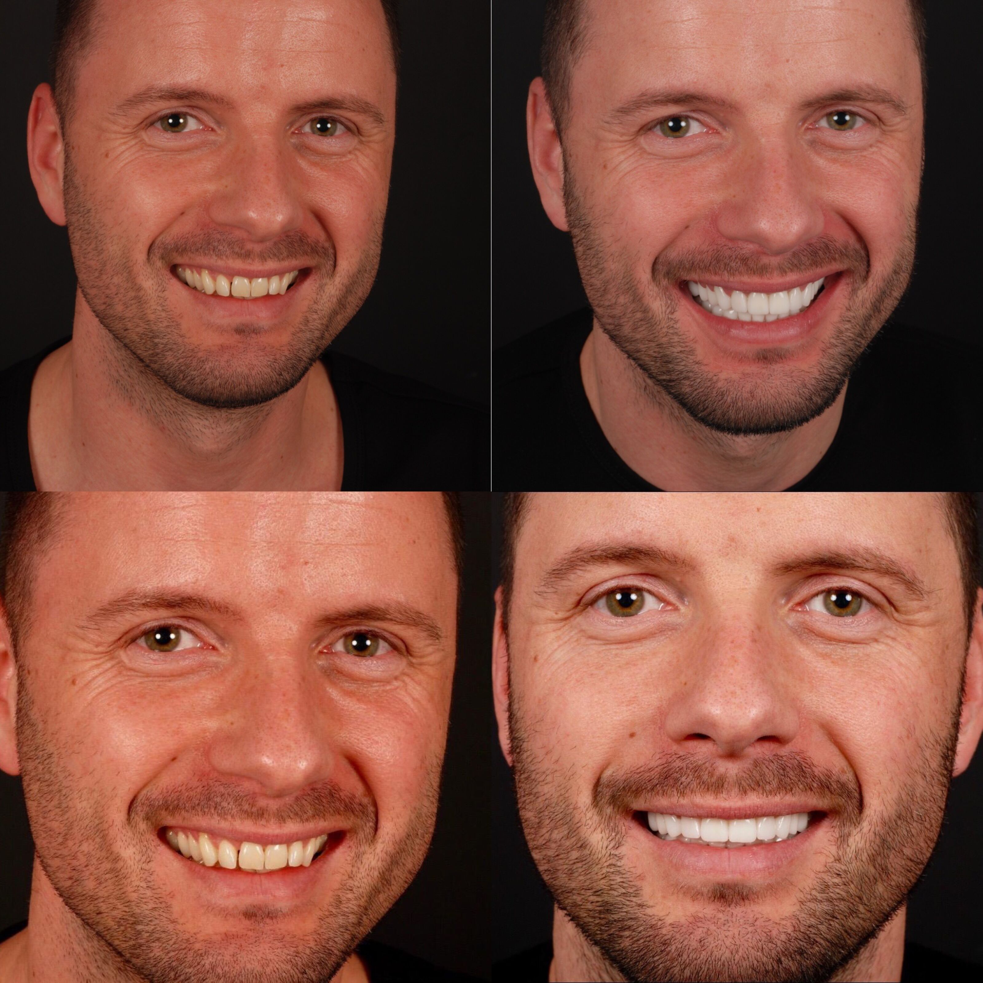 Nieuw gebit voor Gordon in Turkije